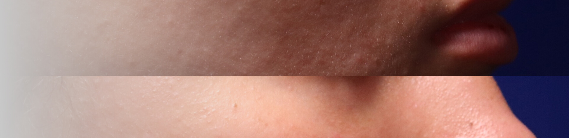 Hypertrophic Scars Treatment Before And After Scar Healing And