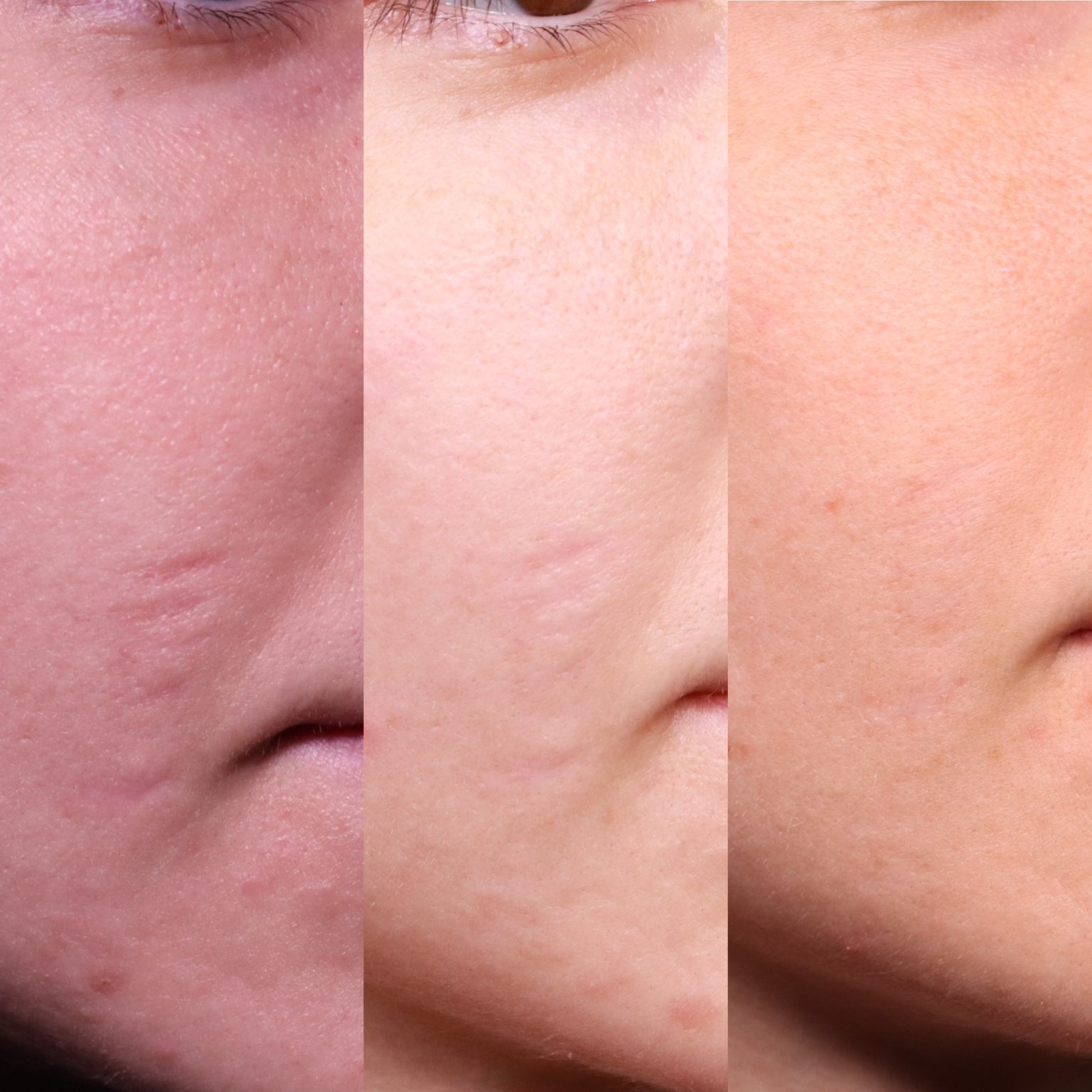 Planning Subcision For Acne Scar Treatment? Read This First
