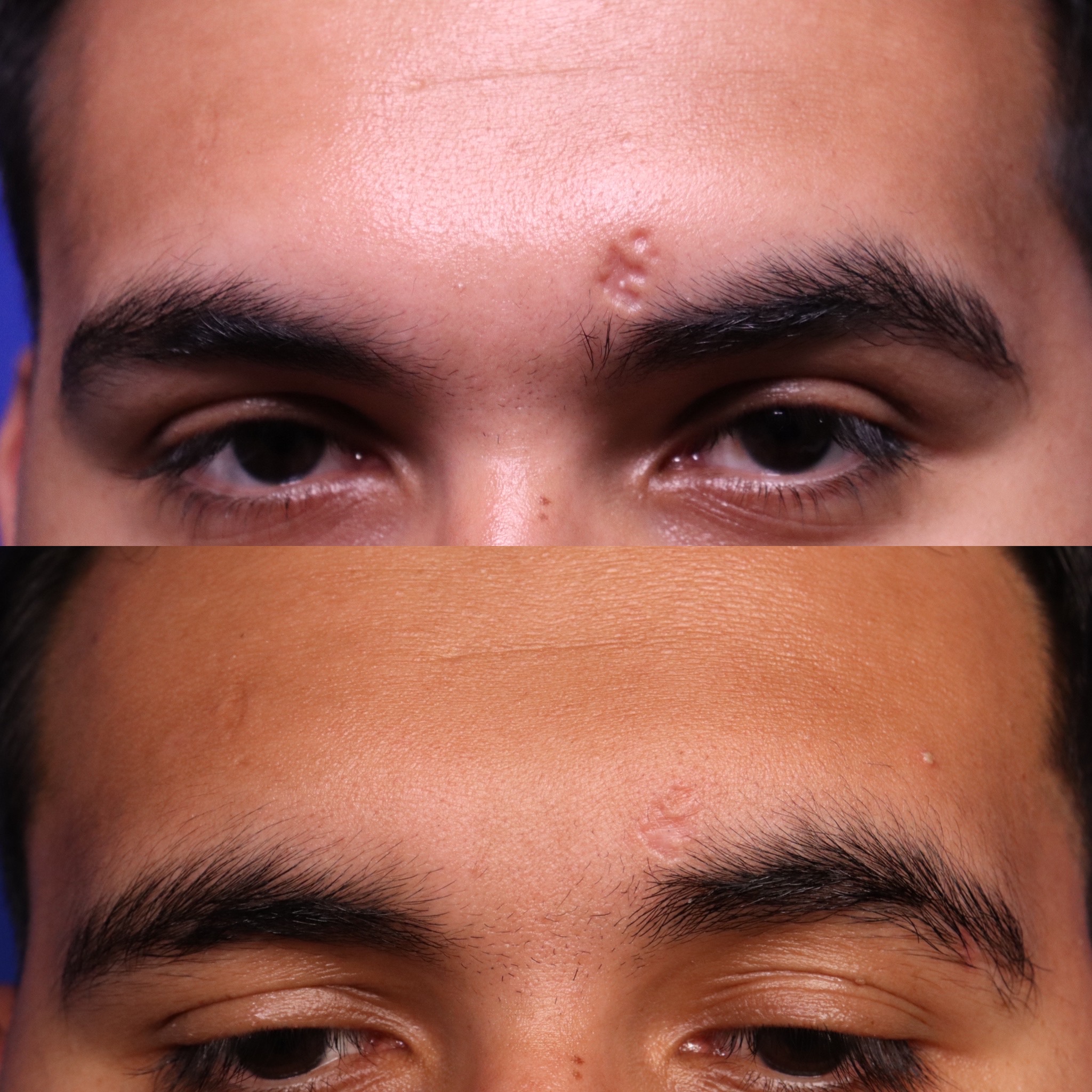 Atrophic Scar Treatment Before And After Atrophic Scar Treatment Before And After