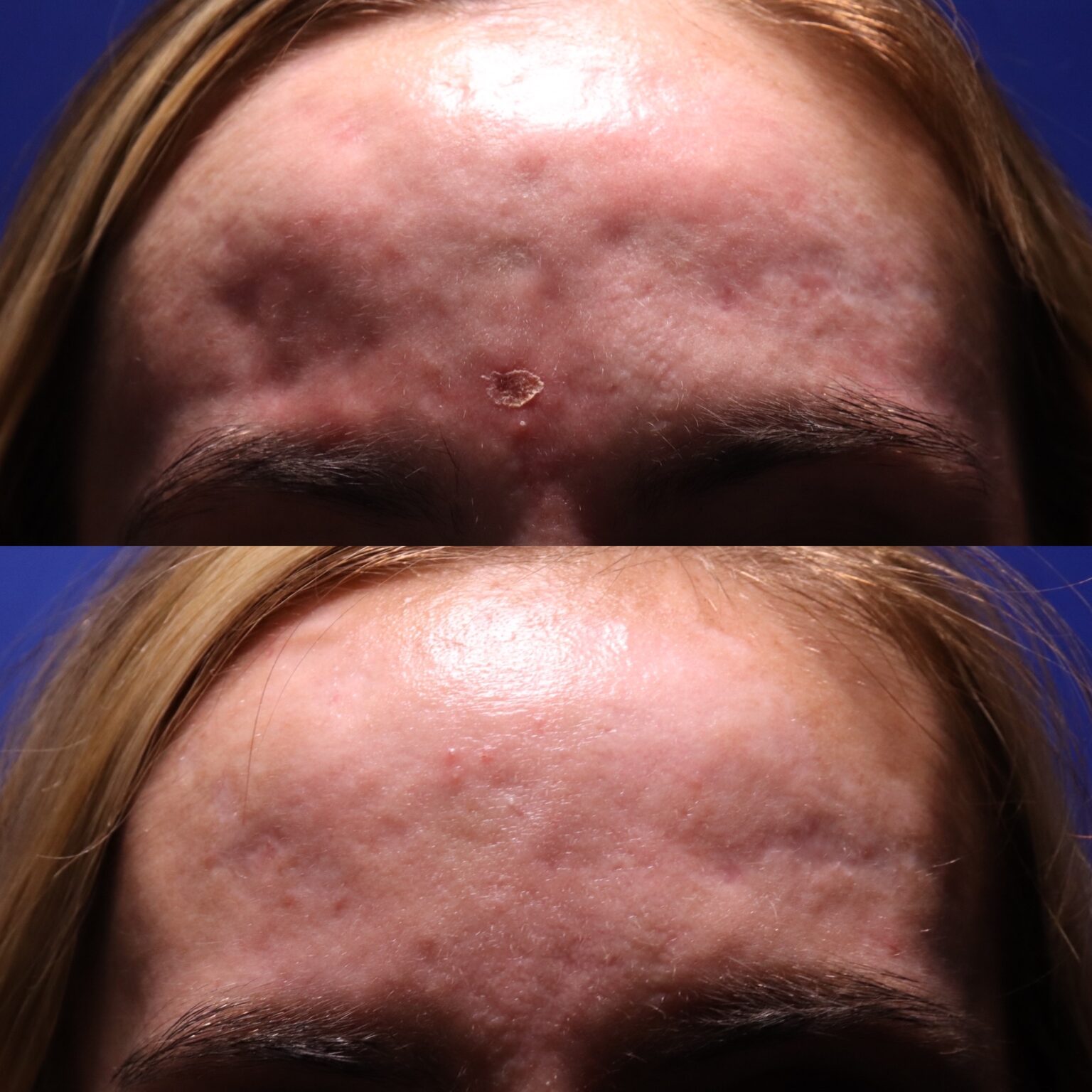 Non-Acne Scar Healing Treatments Before and After Gallery