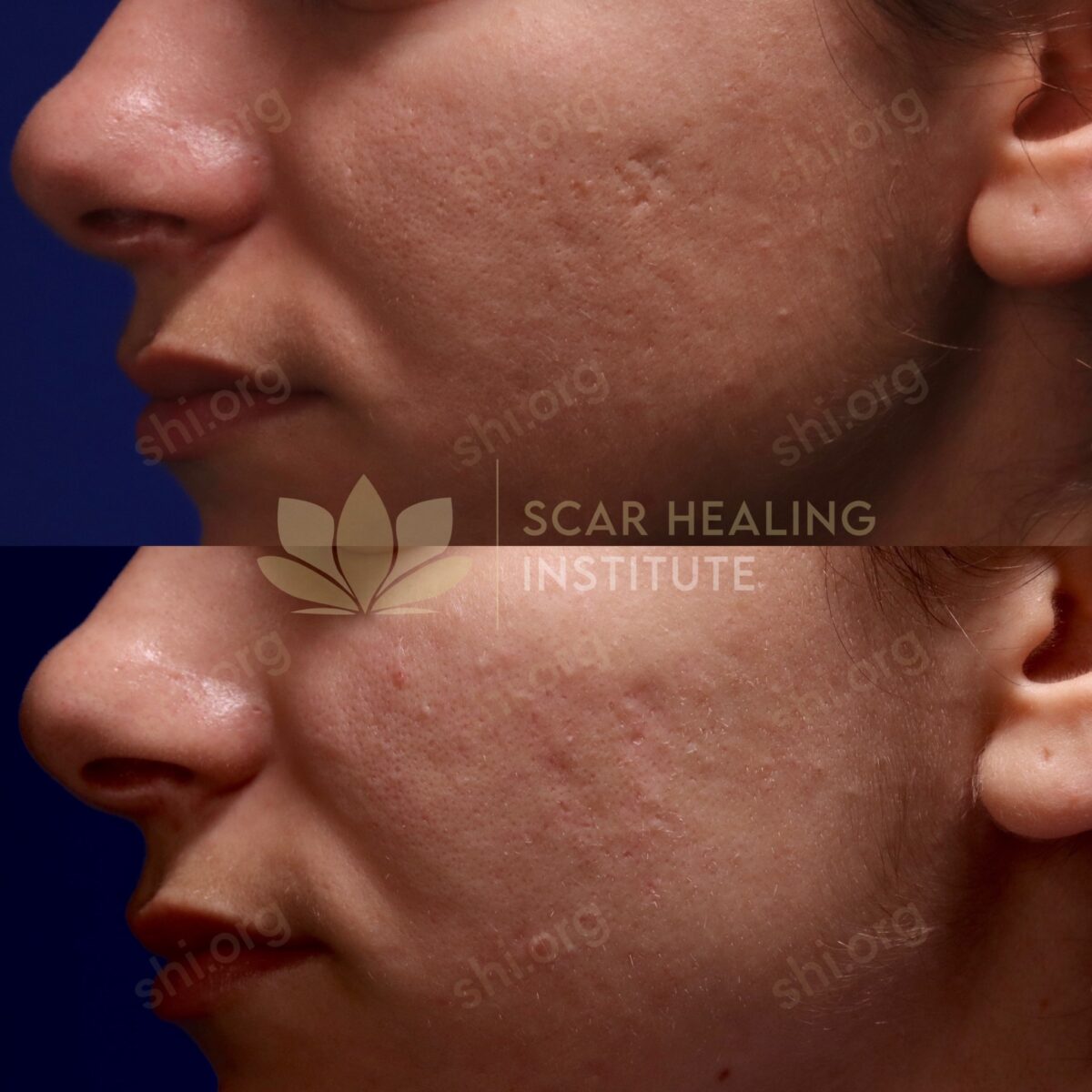 The Natural Healing Process of Acne Scars: What to Expect