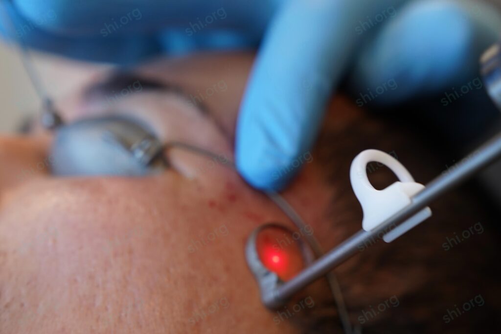 Laser Resurfacing Tustin | Top Skin Renewal Provider