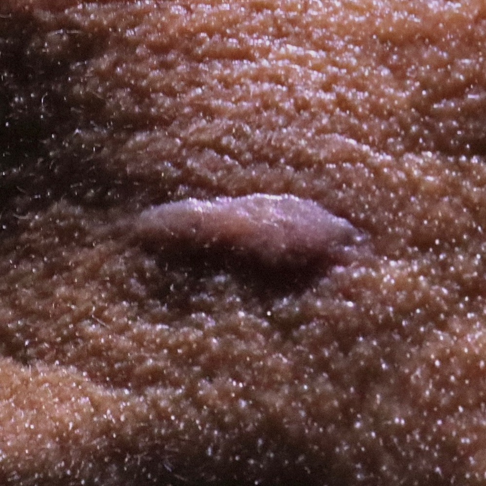 Patient #98 | Scar Healing And Treatment Institute In Los Angeles ...