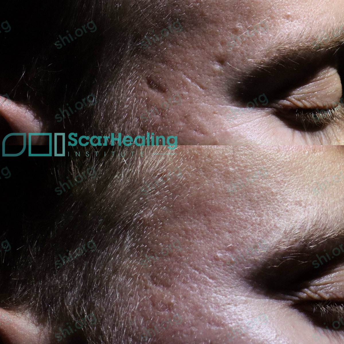 Acne Scar Treatment Los Angeles & Beverly Hills | 200+ 5-Stars