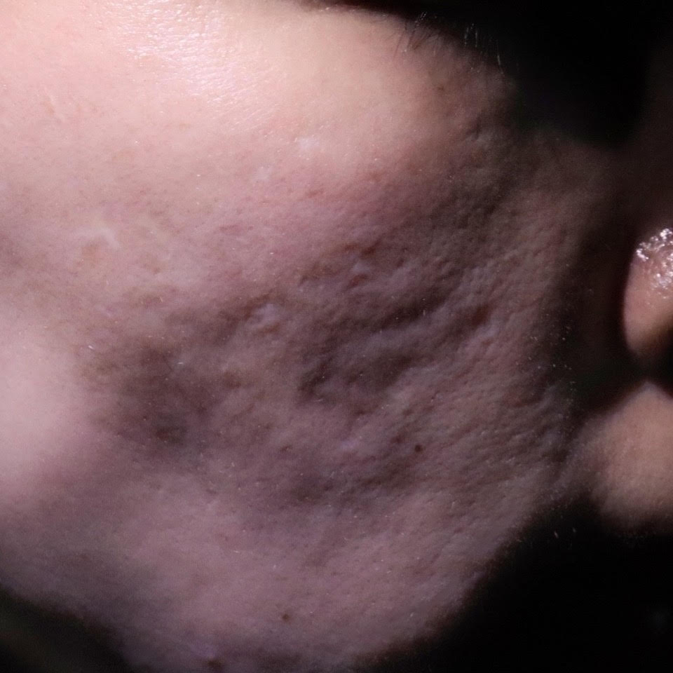 Acne Scar Treatment | Advanced Techniques & Proven Results